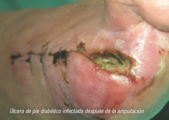 Úlcera de pie diabético: la importancia de identificar y controlar la ...
